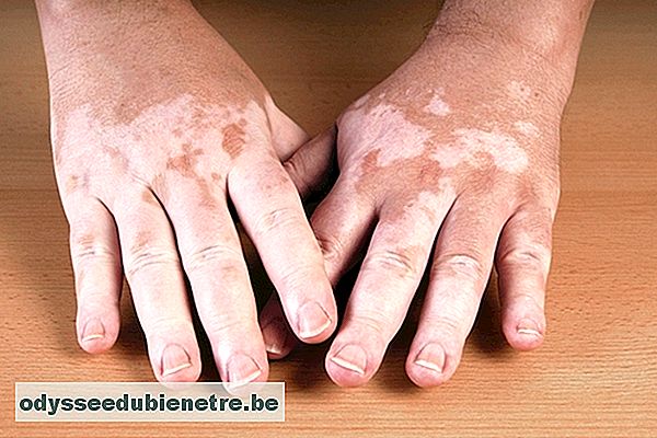 C mo Quitar Los 8 Tipos De Manchas En La Piel M s Comunes Es odysseedubienetre be